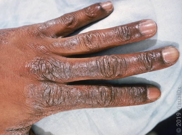 What Is Atopic Dermatitis? • OnSpot Dermatology
